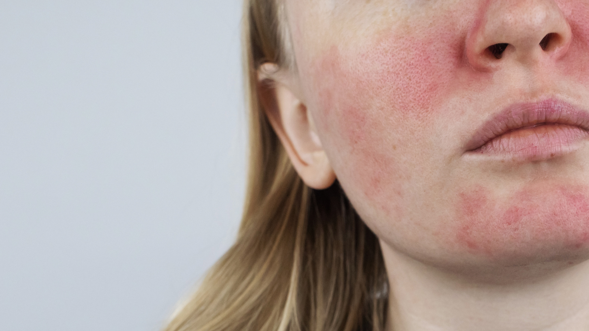 SIBO och rosacea - så hänger allt ihop – Gutfeeling Labs